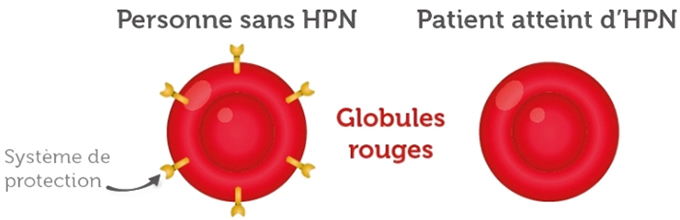 Qu’est-ce que l’HPN - HPN et Moi
